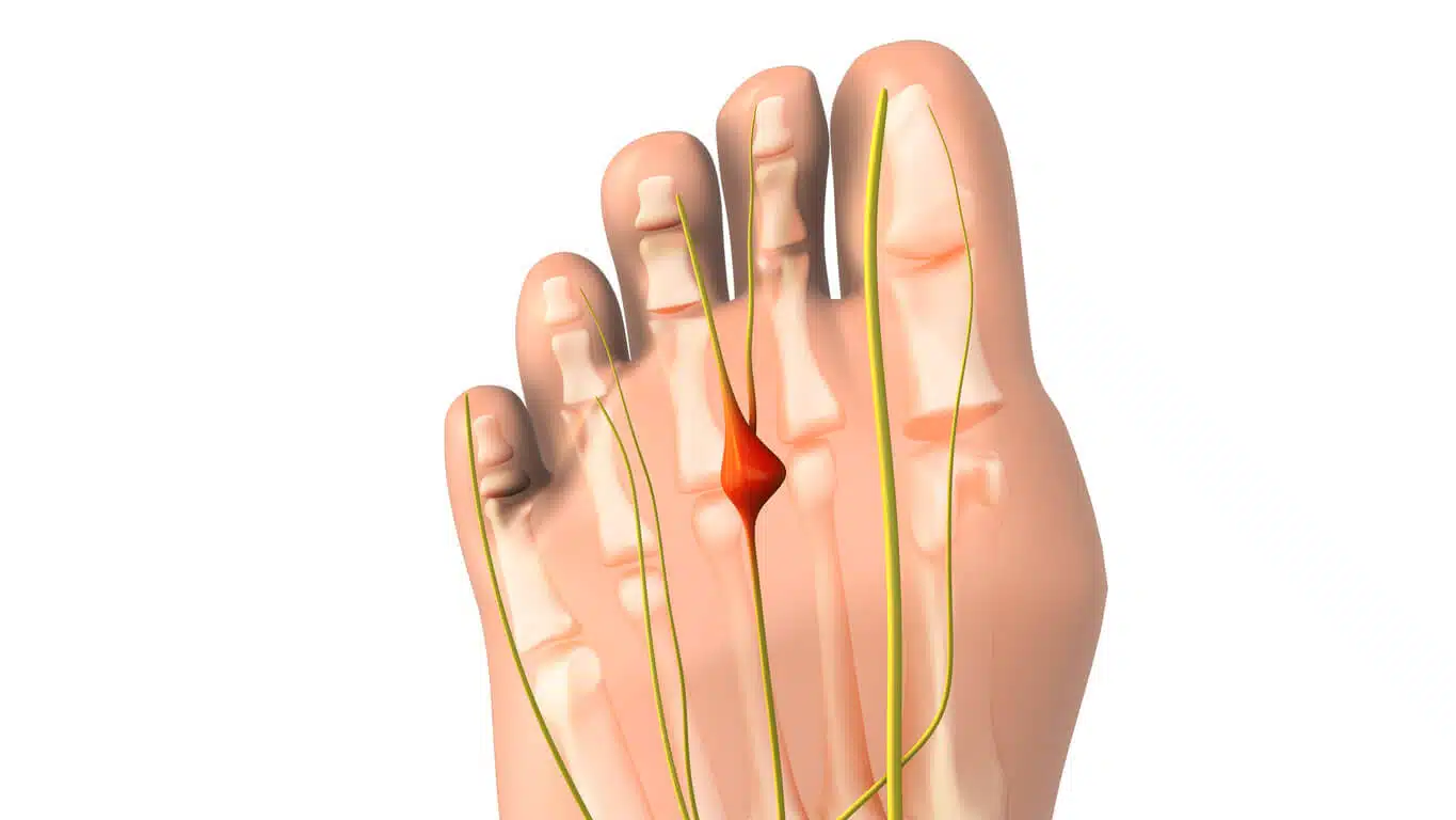 Morton’s Neuroma Treatment: Surgery vs. Conservative Care